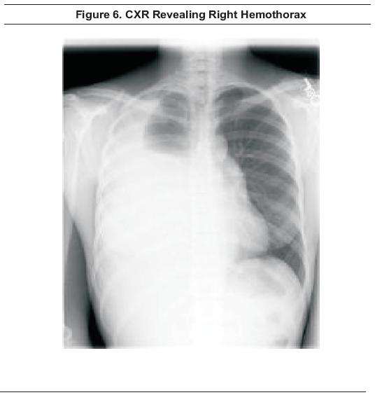 Left Hemothorax X Ray